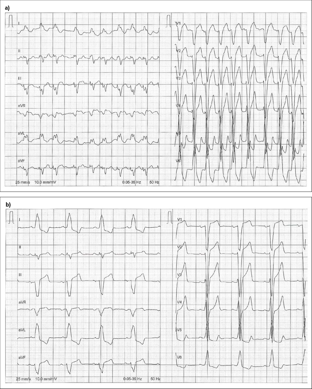 Update Herzrhythmusstörungen - Kardiologie & Gefässmedizin - Universimed - Knowledge that matters
